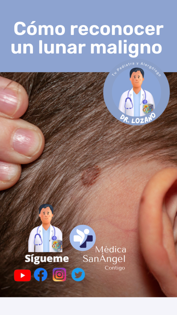 Cómo reconocer cáncer en un lunar | Médica San Ángel 📞 2288410181 🚨 ...
